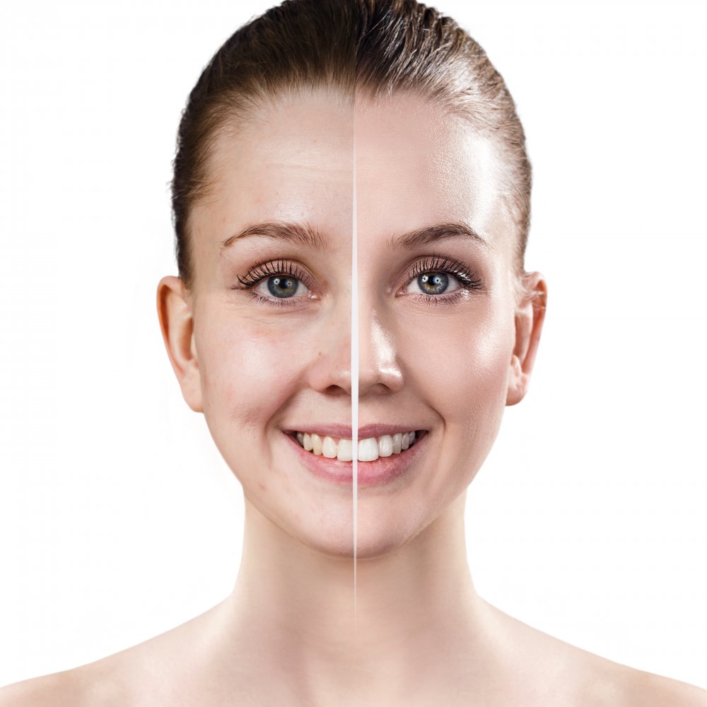 Noninvasive Fat Reduction Technology includes RF | The New Hot Trend