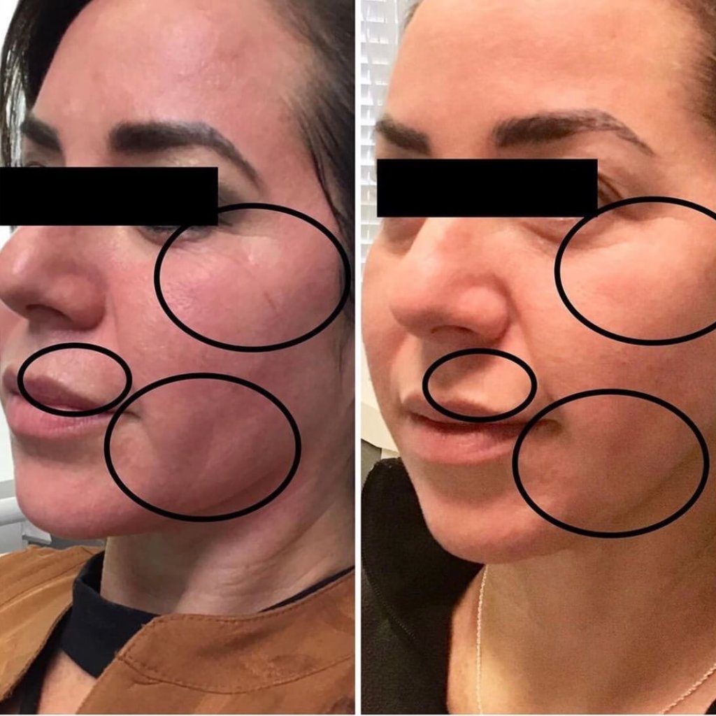 CoolPeel CO2 Laser | Best In Class Skin Rejuvenation | Slater Aesthetics