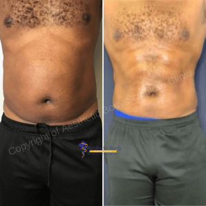 PHYSIQ #1 in Body Contouring & Muscle Toning | Now offered in Atlanta